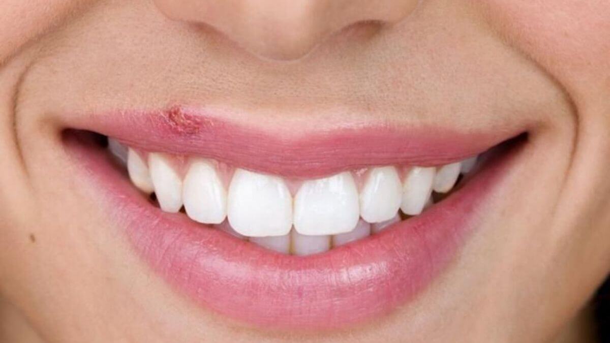 Boutons de fièvre : les causes et les symptômes | SantiShop